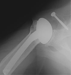 Neer Shoulder Prostheses