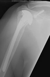 Neer Shoulder Prostheses