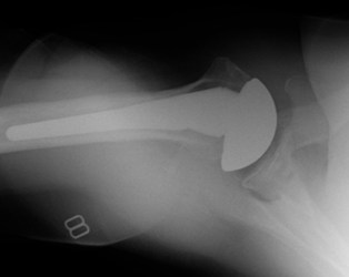 Common US Shoulder Prostheses