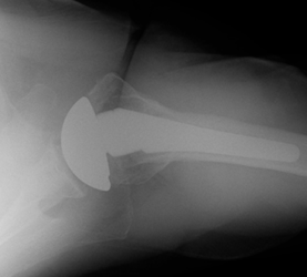 Common US Shoulder Prostheses
