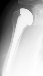 Common US Shoulder Prostheses