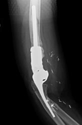 Elbow Prostheses