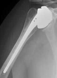 Styker Shoulder Prostheses