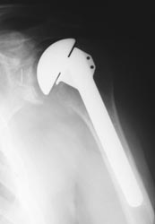 Zimmer Shoulder Prostheses