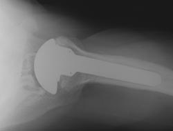 Zimmer Shoulder Prostheses