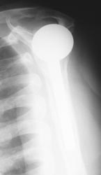 Zimmer Shoulder Prostheses