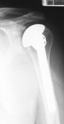 Zimmer Shoulder Prostheses