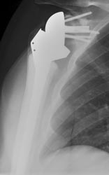 Reverse Shoulder Prostheses