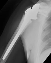 Reverse Shoulder Prostheses