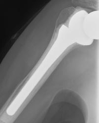 Reverse Shoulder Prostheses