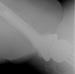 Reverse Shoulder Prostheses