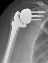 Reverse Shoulder Prostheses