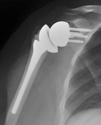 Reverse Shoulder Prostheses