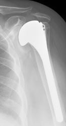Common US Shoulder Prostheses