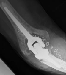 Elbow Prostheses