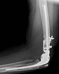 Elbow Prostheses