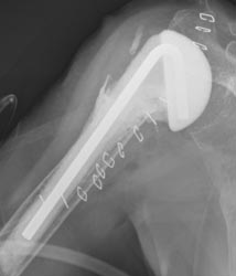 Exactech Shoulder Prostheses