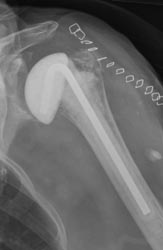 Exactech Shoulder Prostheses