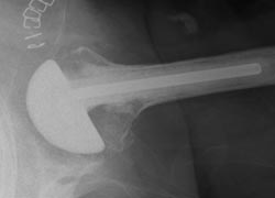 Exactech Shoulder Prostheses