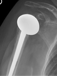 Common US Shoulder Prostheses