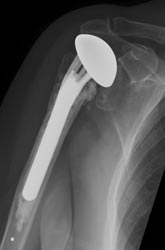 Tornier Shoulder Prostheses