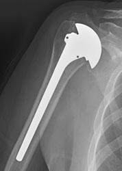DePuy Shoulder Prostheses