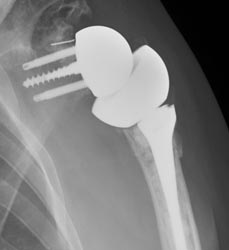 Reverse Shoulder Prostheses