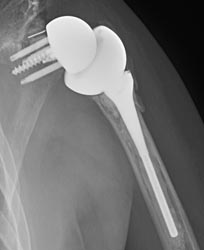 Reverse Shoulder Prostheses