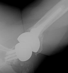 Reverse Shoulder Prostheses