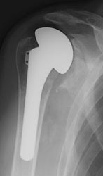 Tornier Shoulder Prostheses