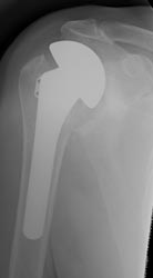 Tornier Shoulder Prostheses