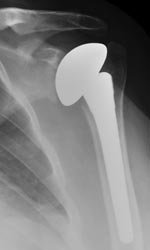Common US Shoulder Prostheses