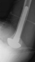 Common US Shoulder Prostheses