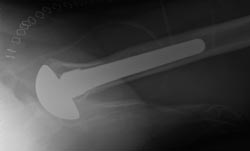 Common US Shoulder Prostheses