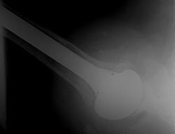 Cofield Shoulder Prostheses