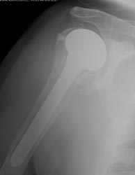 Cofield Shoulder Prostheses