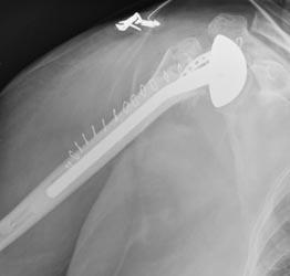 Exactech Shoulder Prostheses
