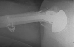 Exactech Shoulder Prostheses