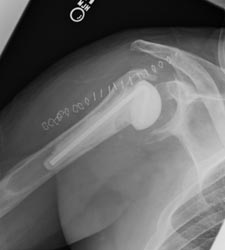 Exactech Shoulder Prostheses