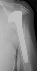 Neer Shoulder Prostheses