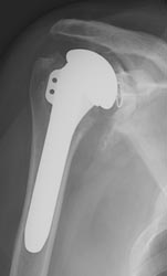 Neer Shoulder Prostheses