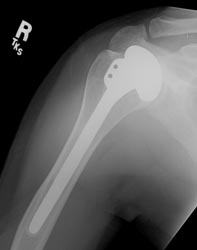 Neer Shoulder Prostheses