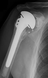 Common US Shoulder Prostheses