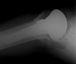 Neer Shoulder Prostheses