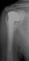 Neer Shoulder Prostheses
