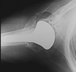 Neer Shoulder Prostheses