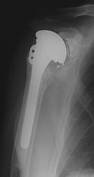 Neer Shoulder Prostheses