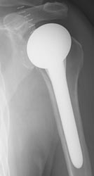 Styker Shoulder Prostheses