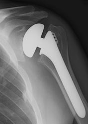 Styker Shoulder Prostheses