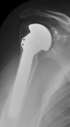 Zimmer Shoulder Prostheses